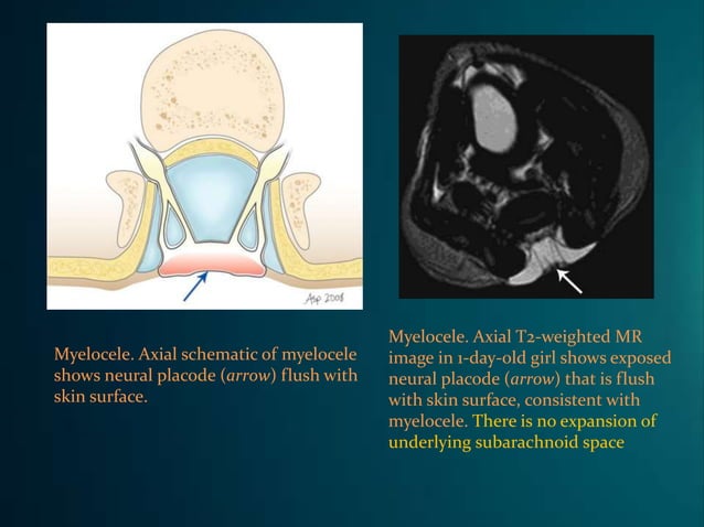 Congenital Anomalies Of Spine And Spinal Cord | PPTX | Brain and Nervous System Disorders ...