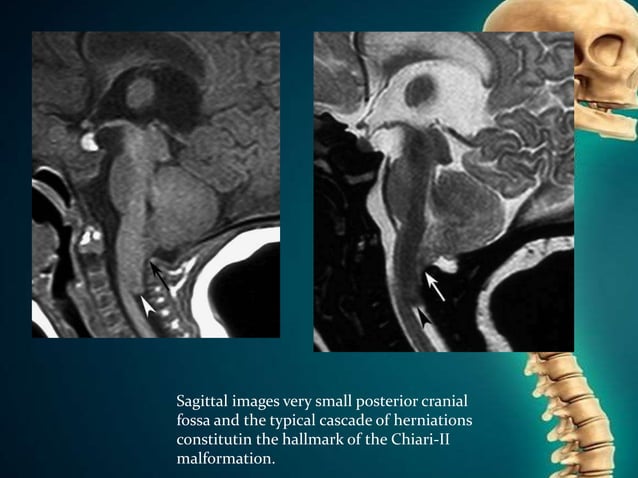 Congenital Anomalies Of Spine And Spinal Cord | PPTX | Brain and Nervous System Disorders ...