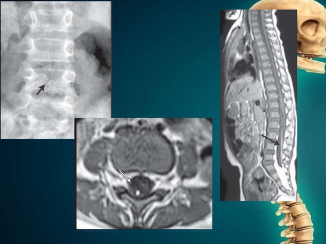 Congenital Anomalies Of Spine And Spinal Cord | PPTX | Brain and Nervous System Disorders ...