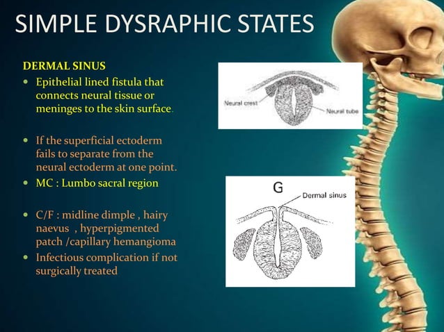 Congenital Anomalies Of Spine And Spinal Cord | PPTX | Brain and Nervous System Disorders ...