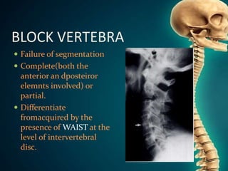 Congenital Anomalies Of Spine And Spinal Cord | PPTX