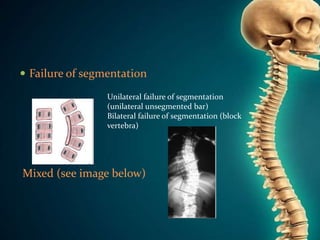 Congenital Anomalies Of Spine And Spinal Cord | PPTX