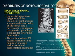 Congenital Defects Of The Spine