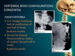 Congenital Anomalies Of Spine And Spinal Cord | PPT