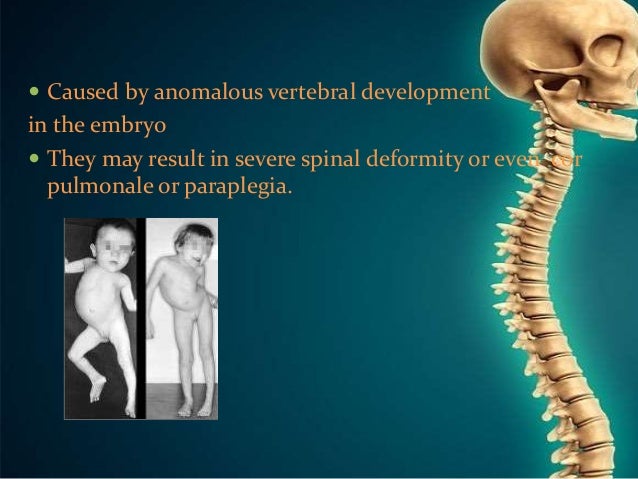 Congenital Anomalies Of Spine And Spinal Cord