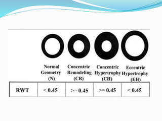 relative wall thickness | PPTX
