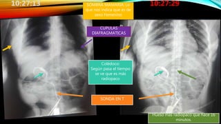 Rx con contraste bilis | PPTX