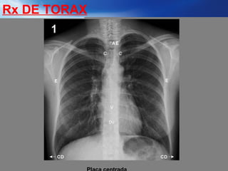 Rx del torax, radiografia del torax | PPT