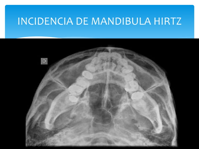 Rx de mandibula | PPTX