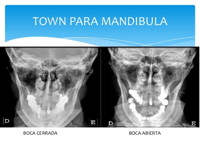 Rx de mandibula