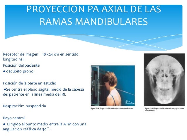 Rx de mandibula
