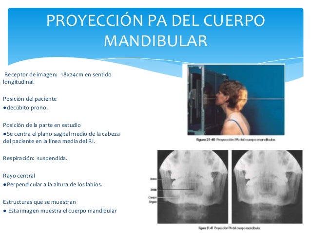 Rx de mandibula