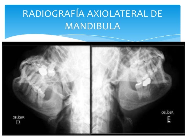 Rx de mandibula