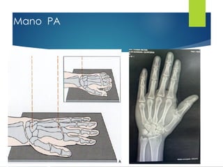 RX DE MANO, proyecciones para lesiones de mano | PPT