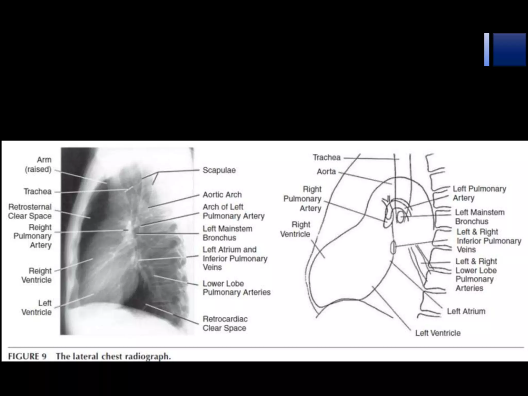 Interpretacion de radiografia PA de torax o tele de torax | PDF