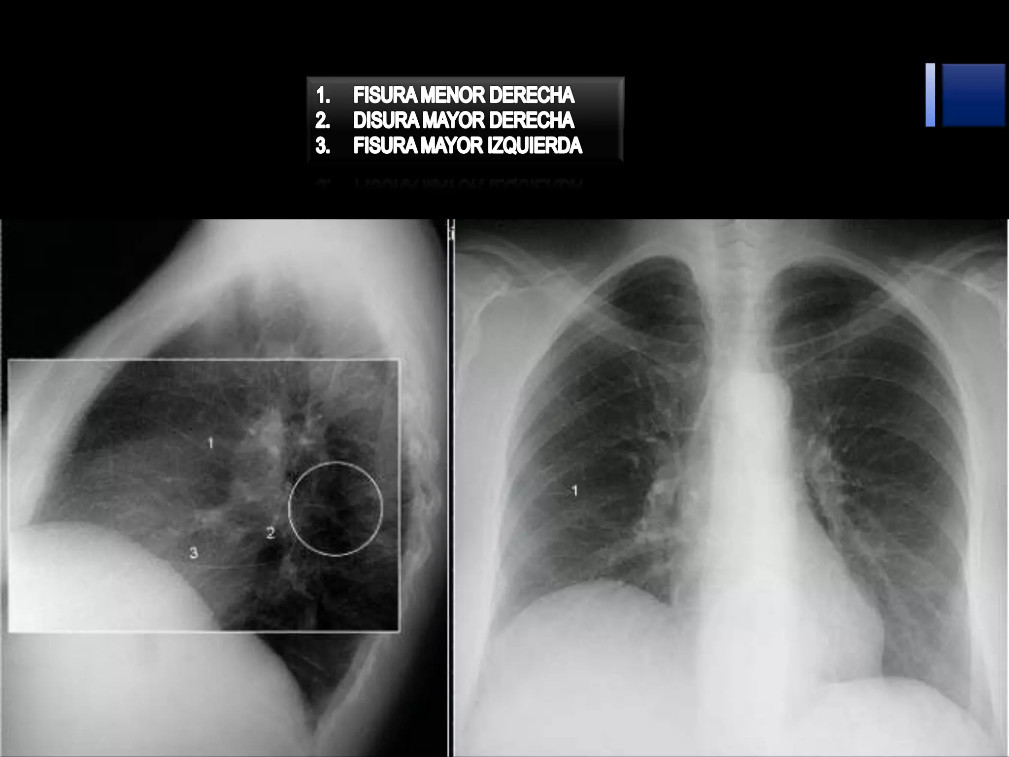Interpretacion de radiografia PA de torax o tele de torax | PDF