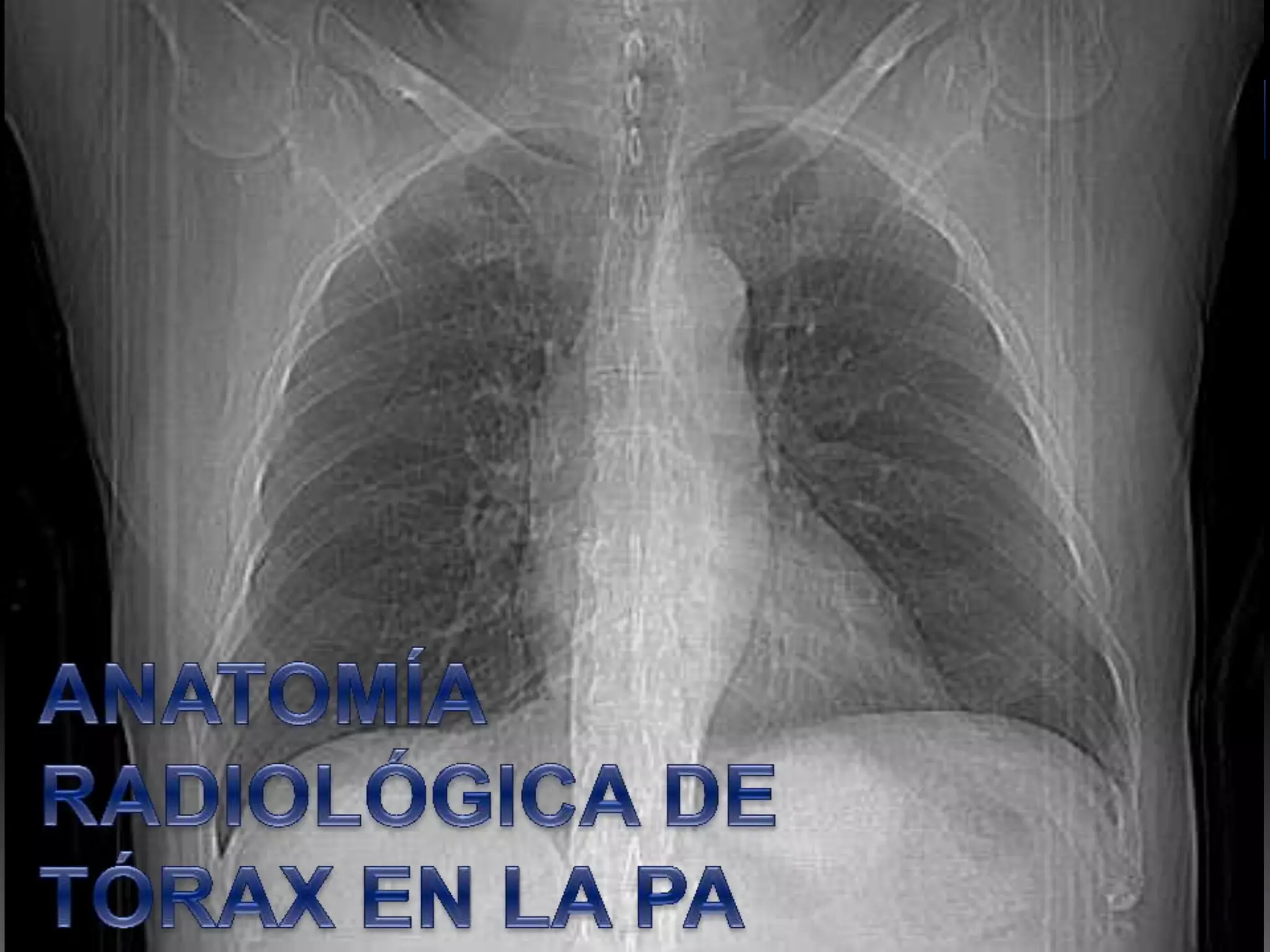 Interpretacion de radiografia PA de torax o tele de torax | PDF