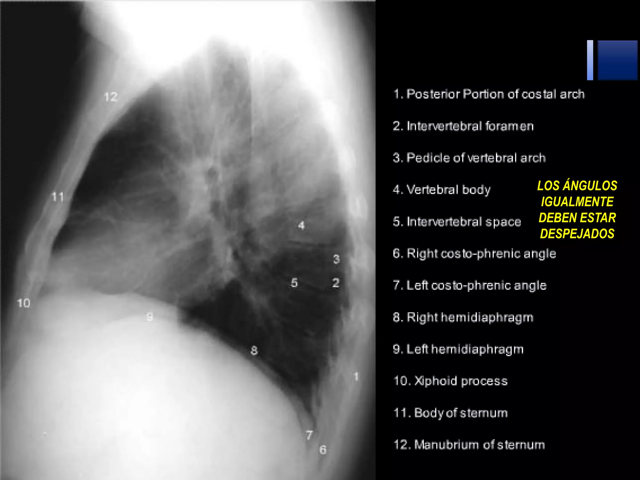 Interpretacion de radiografia PA de torax o tele de torax | PDF