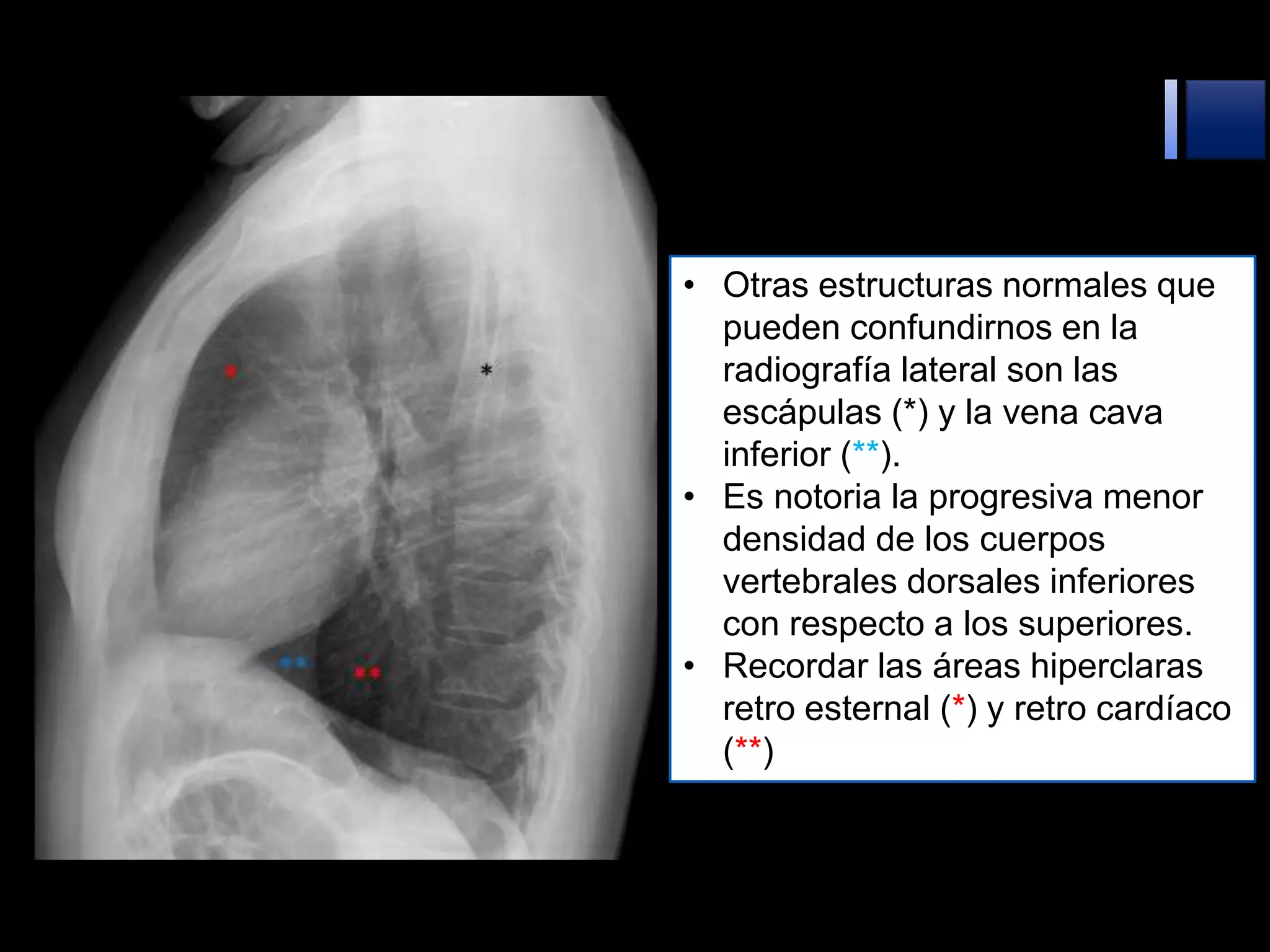 Interpretacion de radiografia PA de torax o tele de torax | PDF