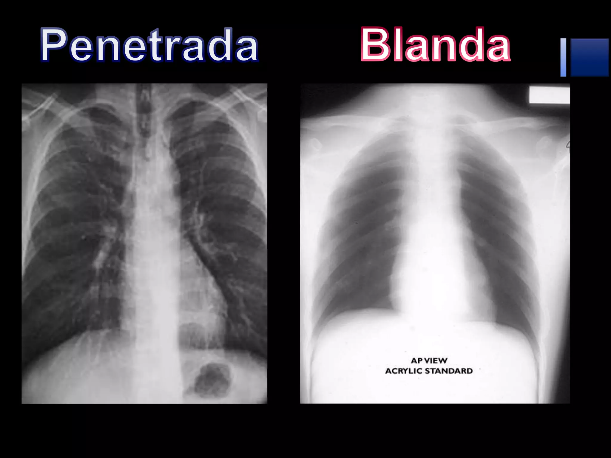 Interpretacion de radiografia PA de torax o tele de torax | PDF