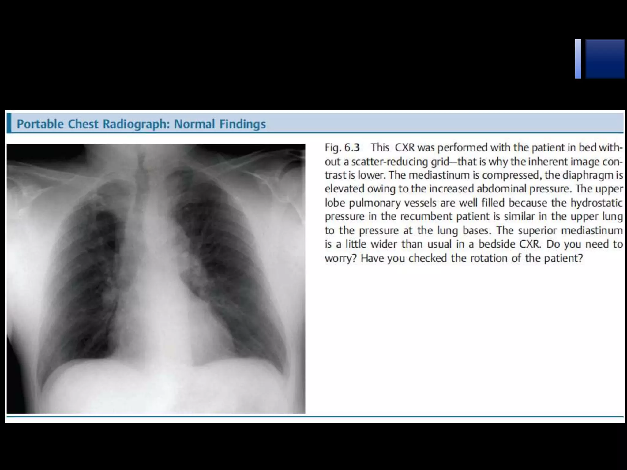 Interpretacion de radiografia PA de torax o tele de torax | PDF
