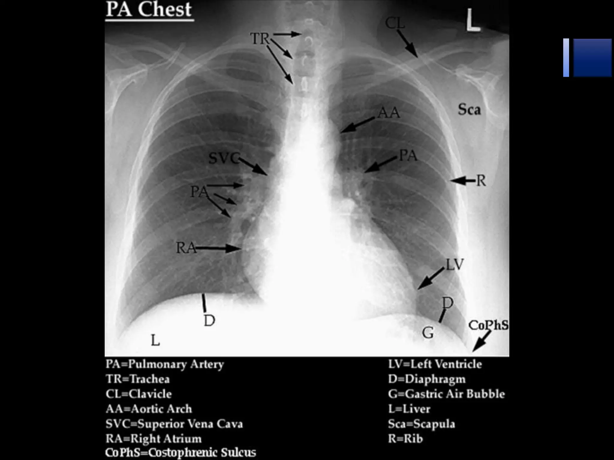 Interpretacion de radiografia PA de torax o tele de torax | PDF