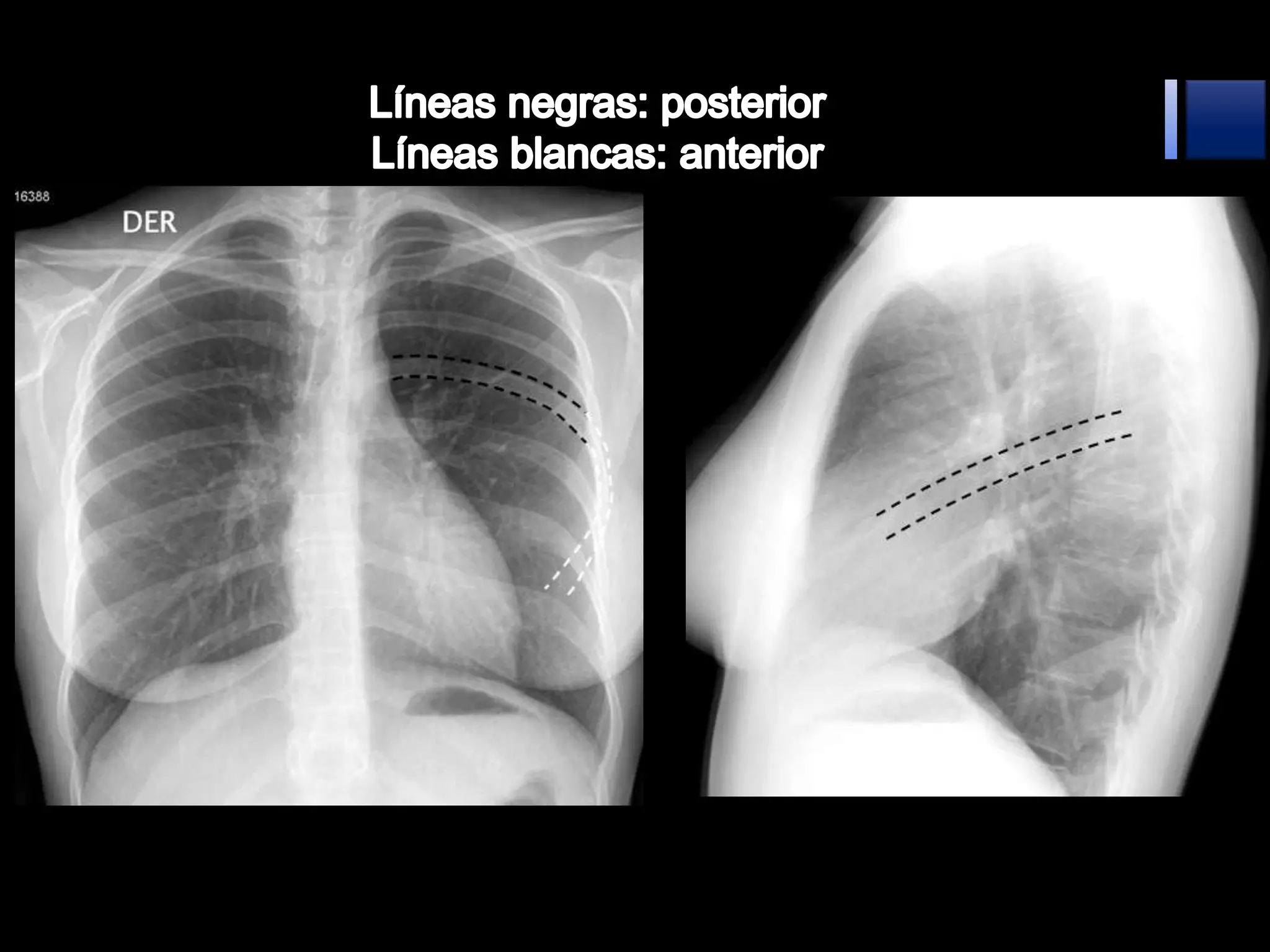 Interpretacion de radiografia PA de torax o tele de torax | PDF