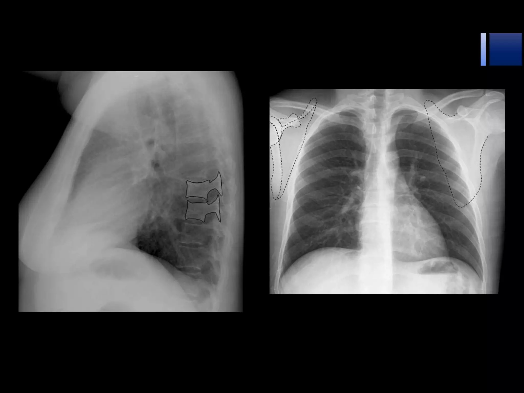 Interpretacion De Radiografia Pa De Torax O Tele De Torax Pdf
