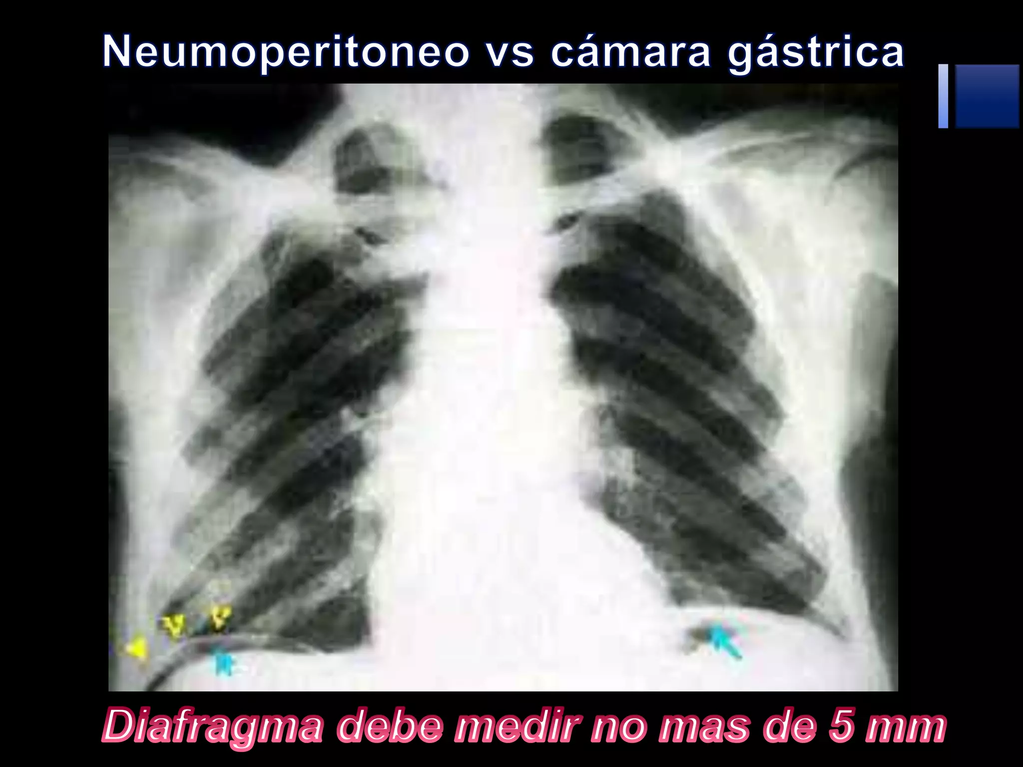 Interpretacion de radiografia PA de torax o tele de torax | PDF