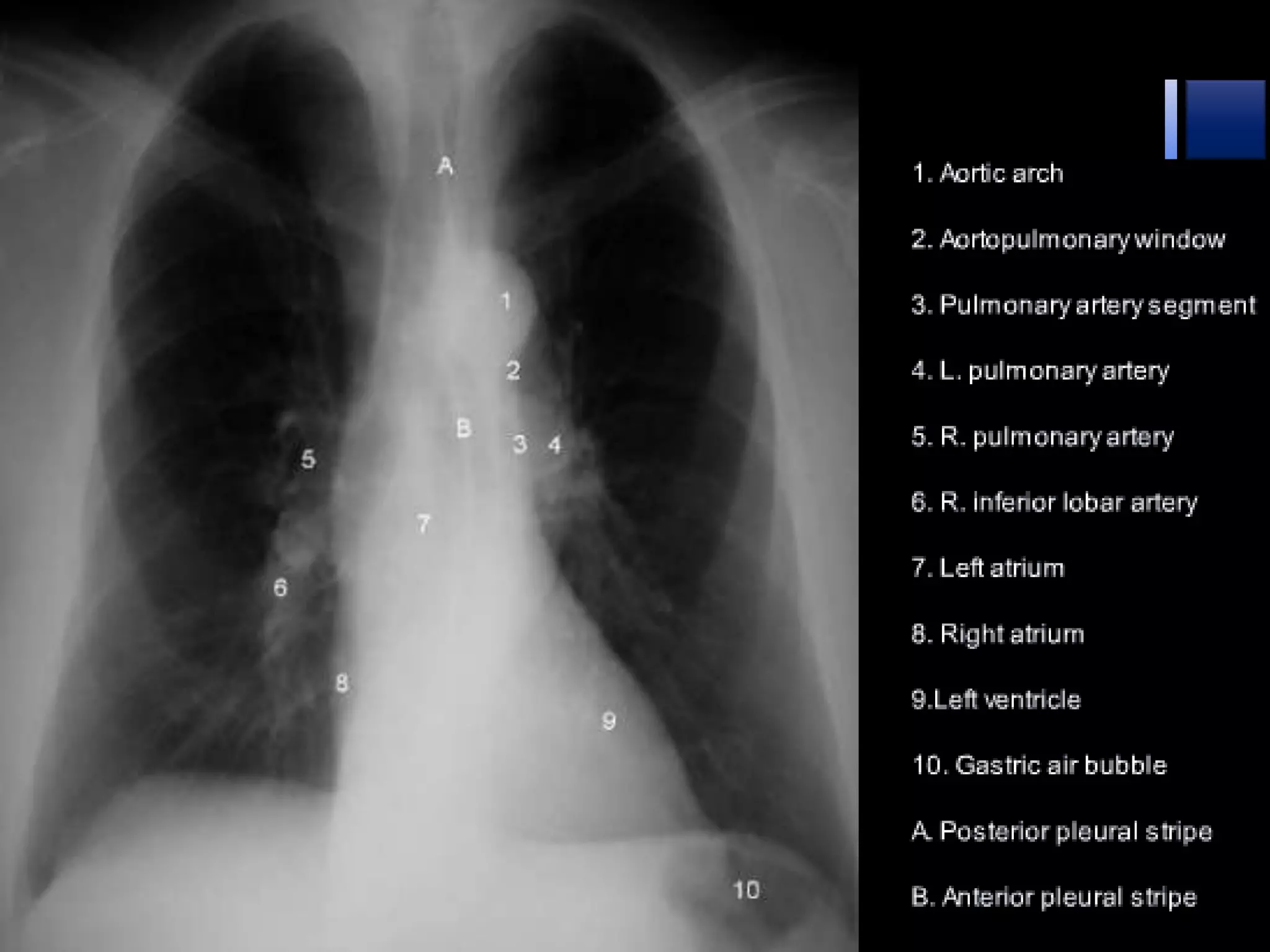 Interpretacion de radiografia PA de torax o tele de torax | PDF