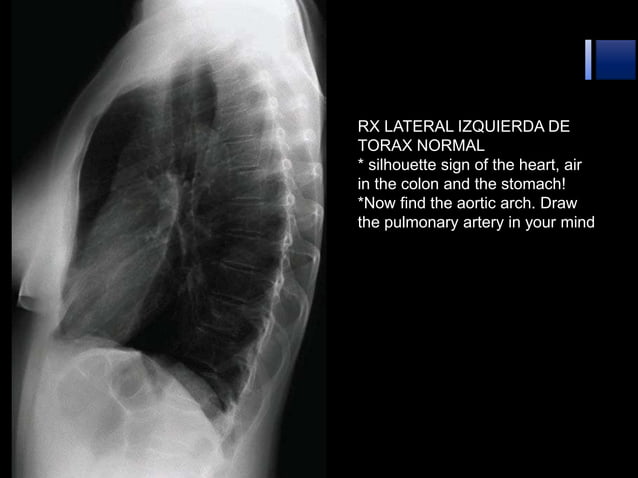 Interpretacion de radiografia PA de torax o tele de torax | PDF