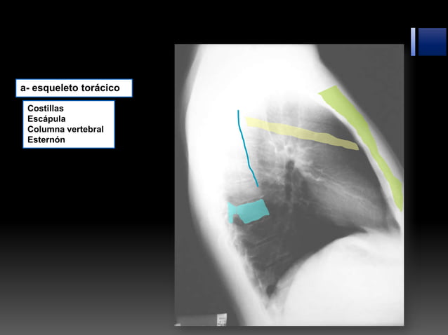 Interpretacion de radiografia PA de torax o tele de torax | PDF