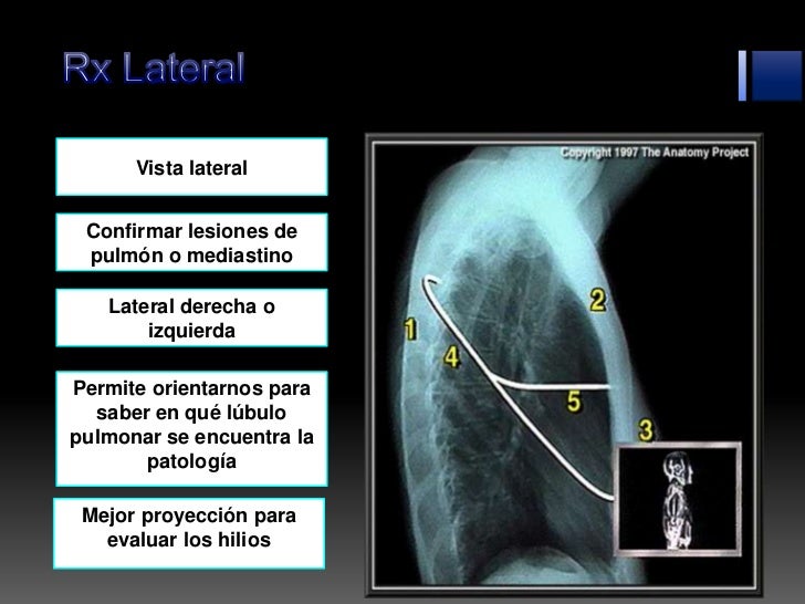 Interpretacion de radiografia PA de torax o tele de torax