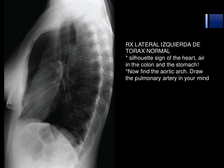 Interpretacion de radiografia PA de torax o tele de torax