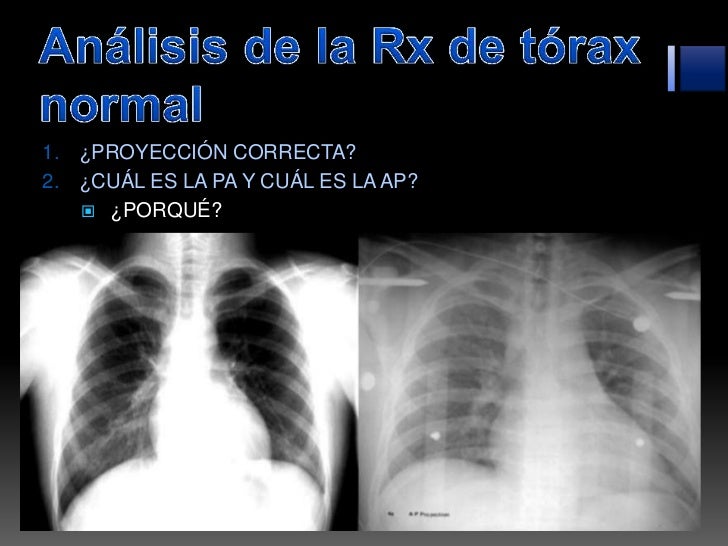 Interpretacion de radiografia PA de torax o tele de torax