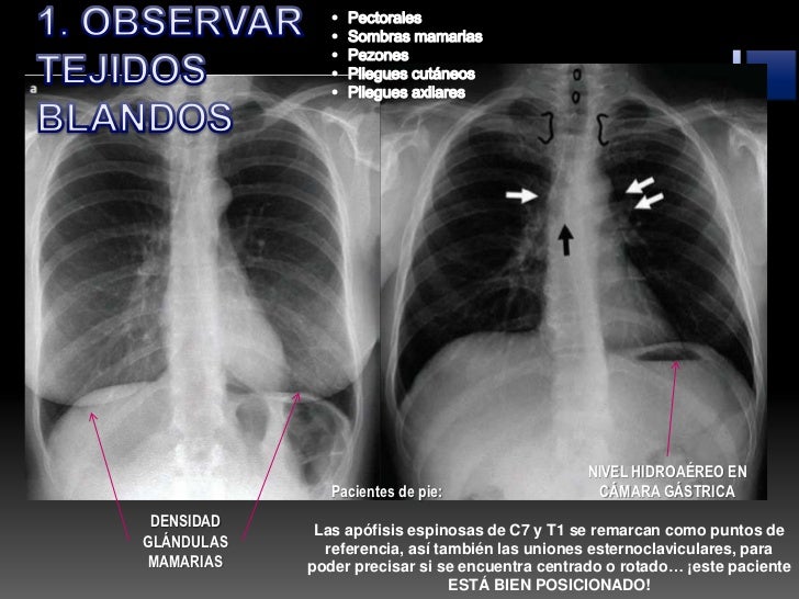 Interpretacion de radiografia PA de torax o tele de torax Interpretacion de radiografia PA de torax o tele de torax