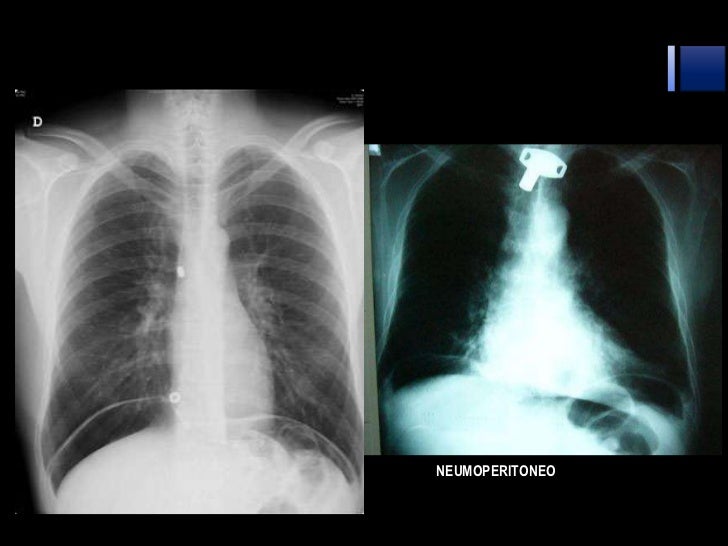 Interpretacion de radiografia PA de torax o tele de torax