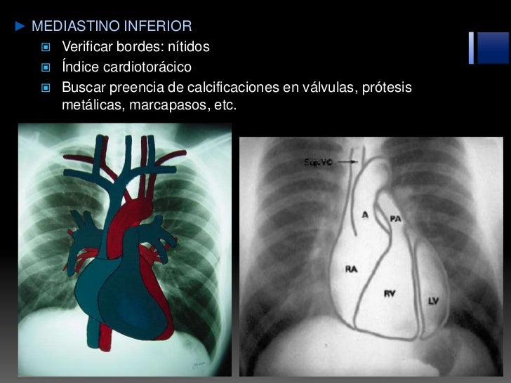 Interpretacion de radiografia PA de torax o tele de torax