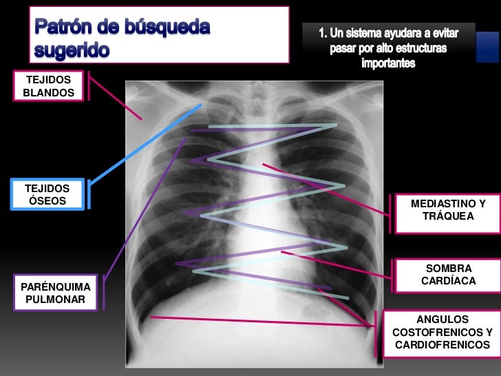 Interpretacion de radiografia PA de torax o tele de torax Interpretacion de radiografia PA de torax o tele de torax