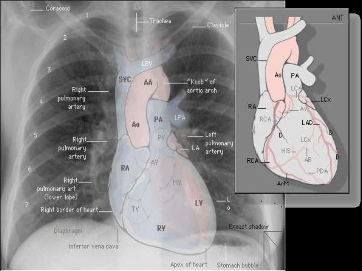 Interpretacion de radiografia PA de torax o tele de torax