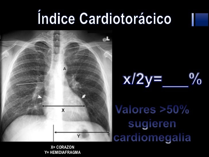 Interpretacion de radiografia PA de torax o tele de torax Interpretacion de radiografia PA de torax o tele de torax