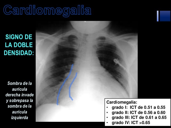 Interpretacion de radiografia PA de torax o tele de torax