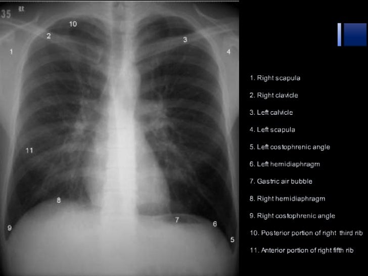 Interpretacion de radiografia PA de torax o tele de torax Interpretacion de radiografia PA de torax o tele de torax