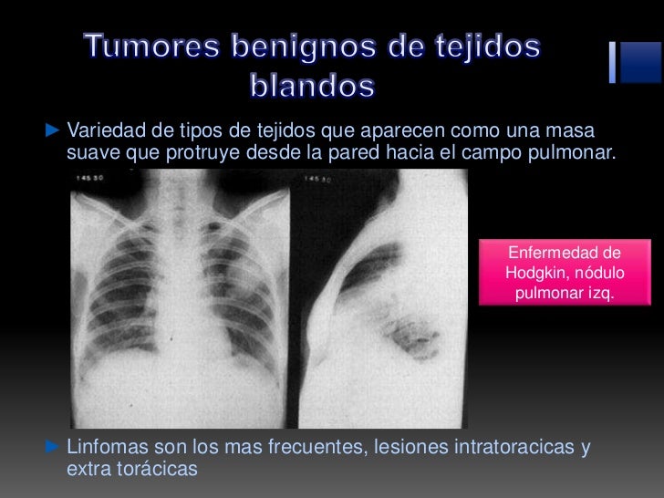 Interpretacion de radiografia PA de torax o tele de torax