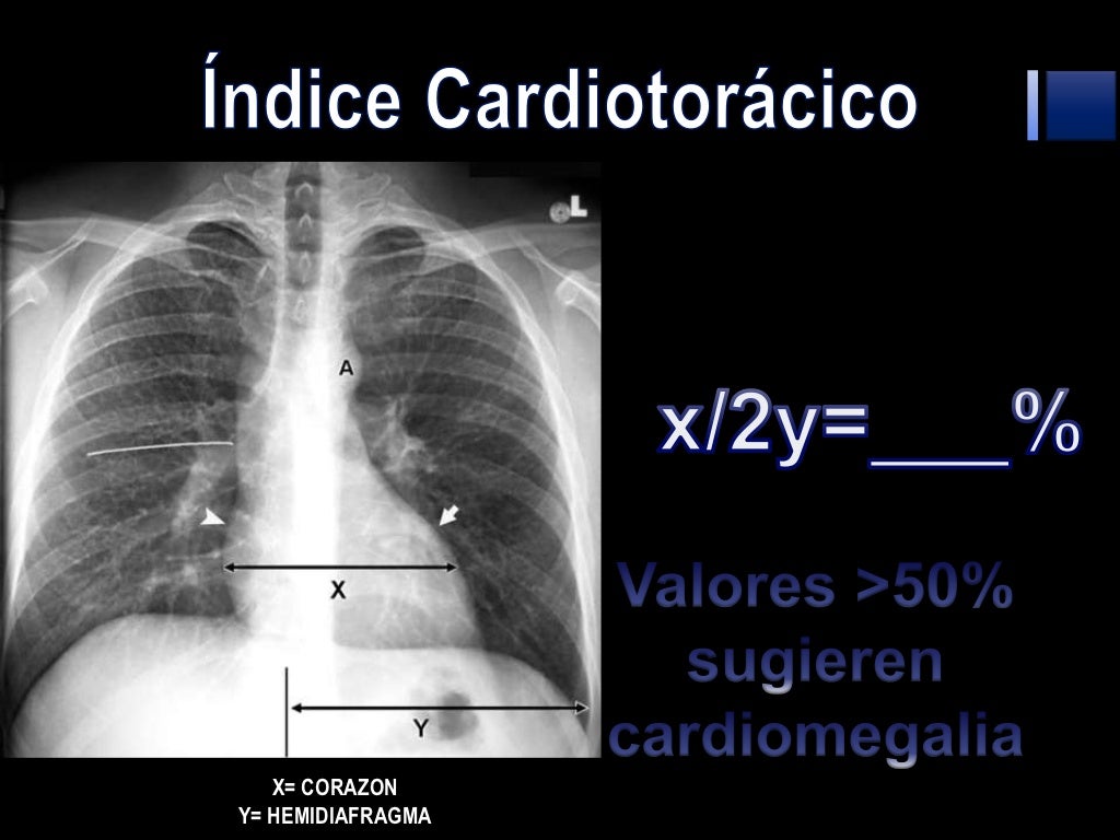 Interpretacion de radiografia PA de torax o tele de torax