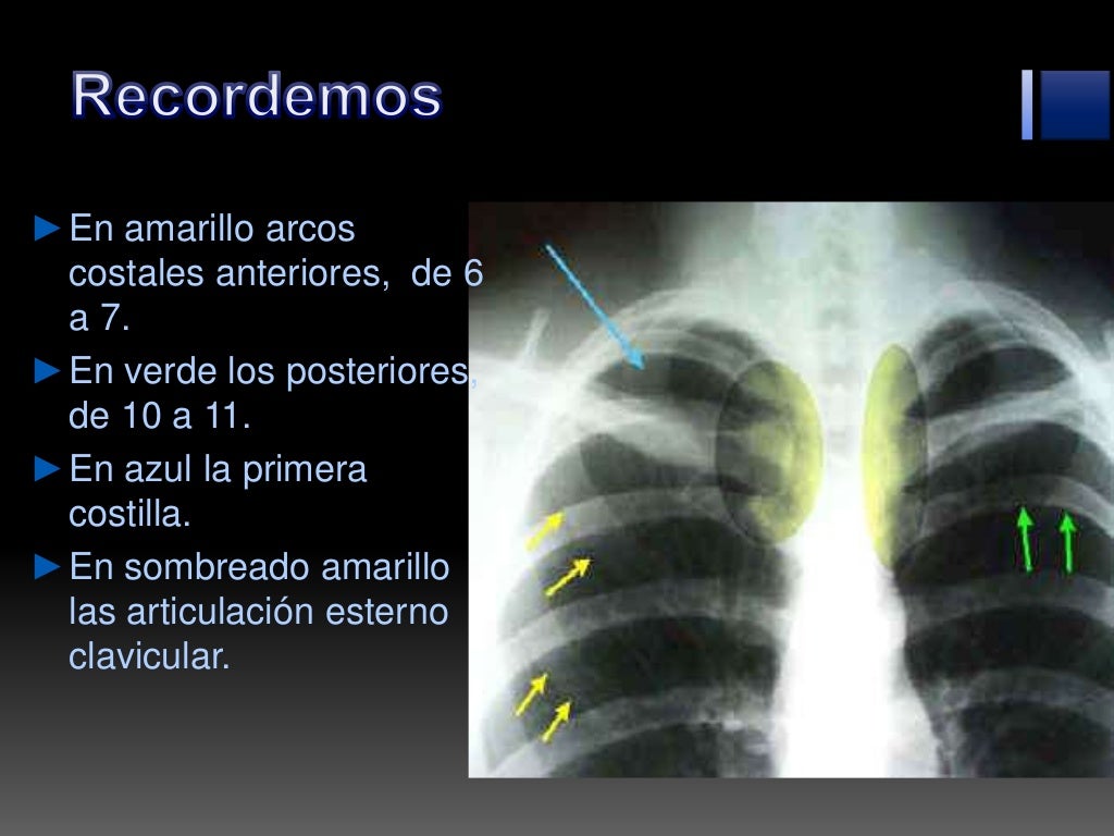 Interpretacion De Radiografia Pa De Torax O Tele De Torax Radiografia Porn Sex Picture