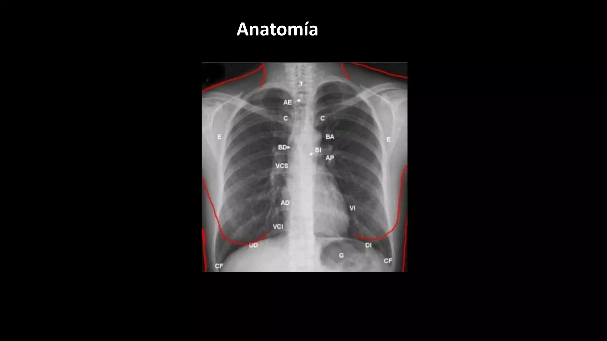RX de torax.pptx | Lung and Respiratory Health | Diseases and Conditions