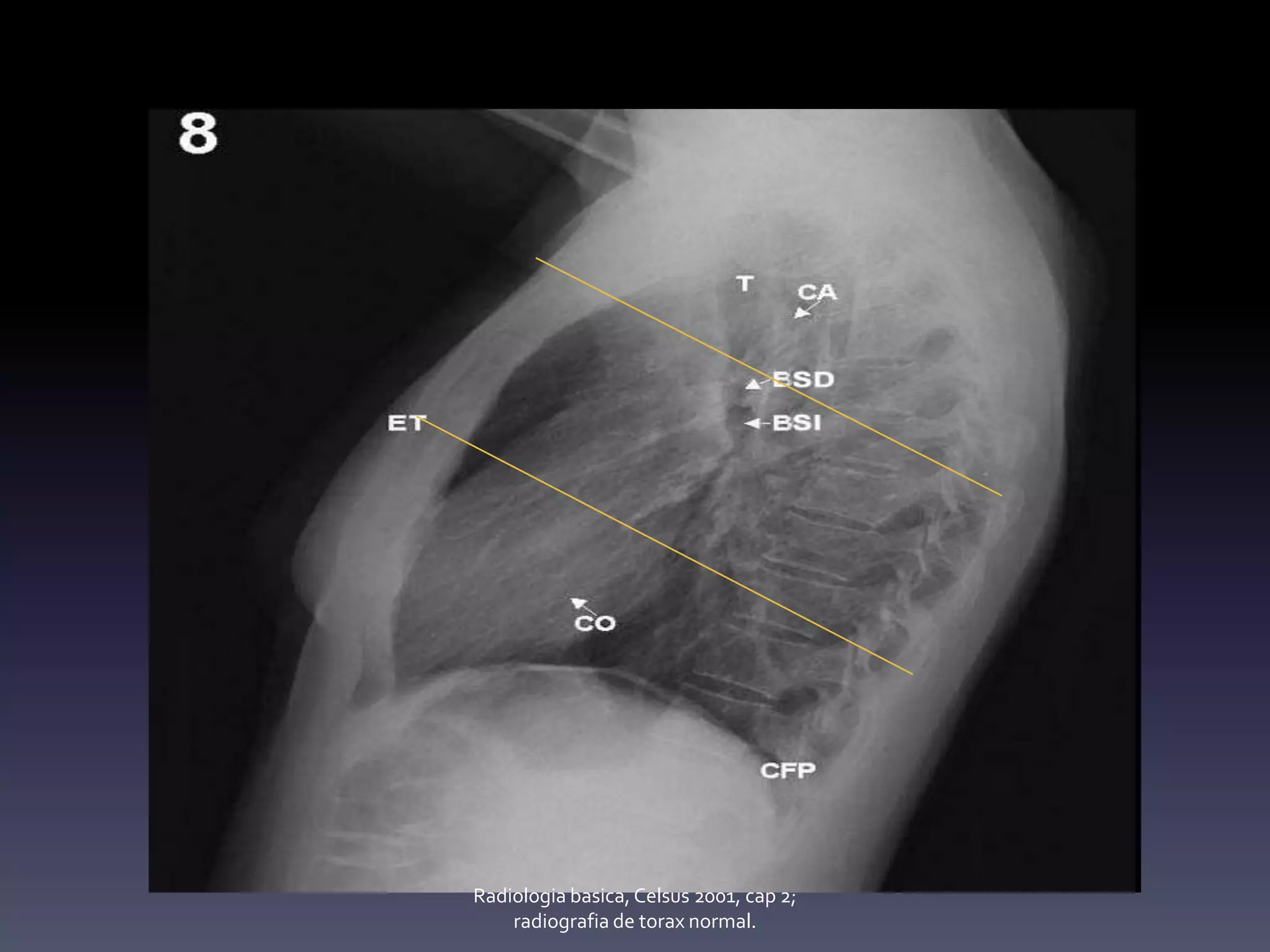 Rx de torax normal | PPTX