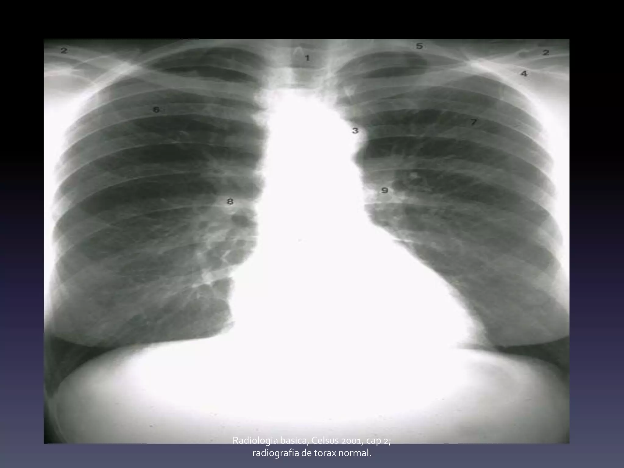 Rx de torax normal | PPTX