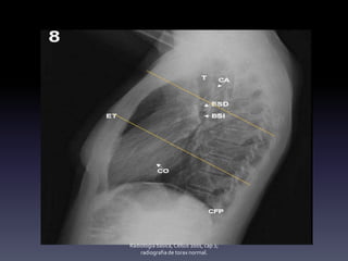 Rx de torax normal | PPTX